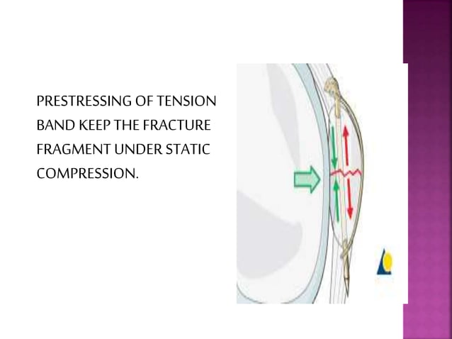 Principle of tension band wiring n its application | PPTX