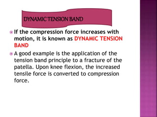 Principle of tension band wiring n its application | PPTX