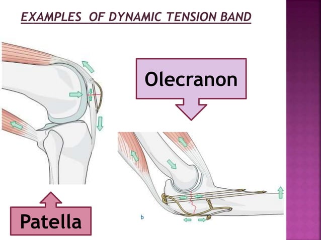 Principle of tension band wiring n its application | PPTX