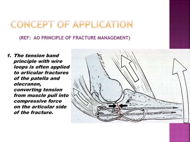 Principle of tension band wiring n its application | PPTX