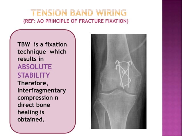 Principle of tension band wiring n its application | PPTX