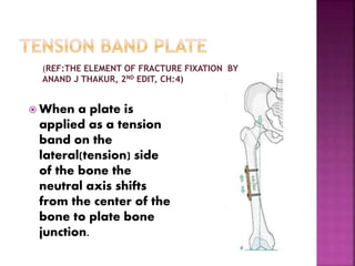 Principle of tension band wiring n its application | PPTX