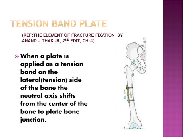 Principle of tension band wiring n its application | PPTX
