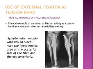 Principle of tension band wiring n its application | PPTX