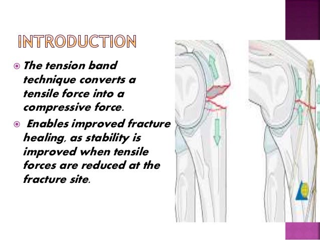 Principle of tension band wiring n its application