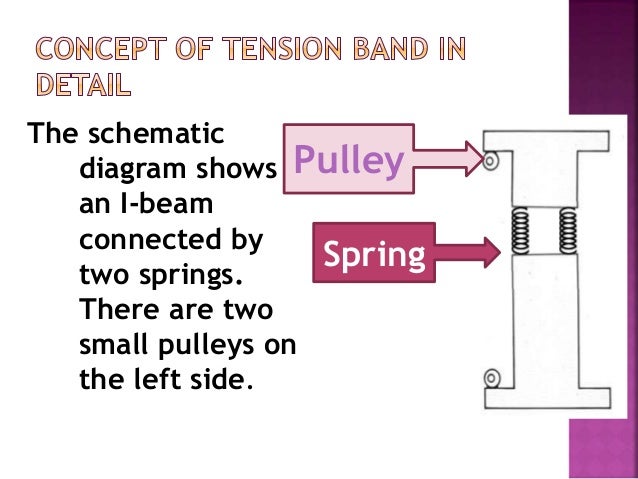 tension band wiring法 – 膝蓋骨骨折 tension band wiring法 – BSKRS