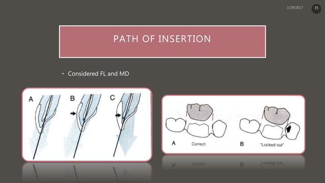 Principle of tooth preparation | PPTX | Dental Health | Diseases and ...