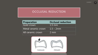 Principle of tooth preparation | PPTX