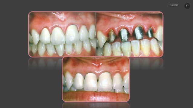 Principle of tooth preparation | PPTX | Dental Health | Diseases and ...