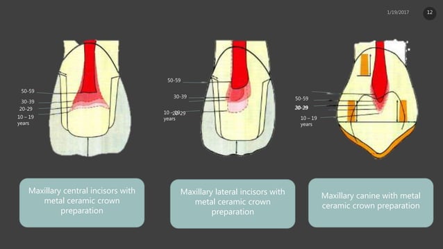 Principle of tooth preparation