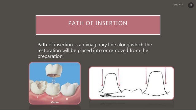 Principle of tooth preparation
