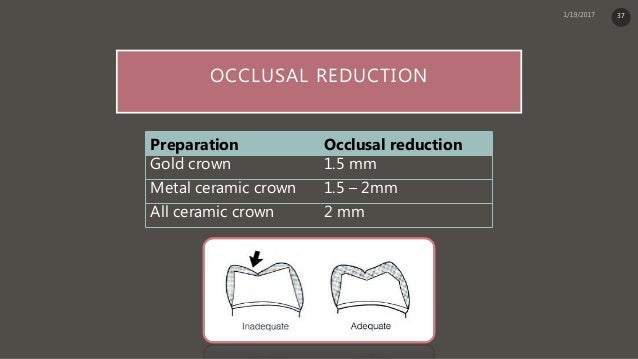 Principle of tooth preparation