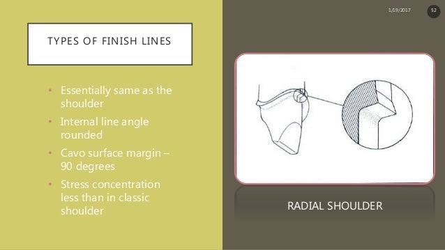 Principle of tooth preparation