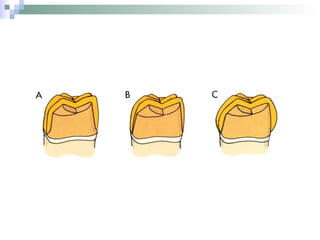 Principle of tooth preparation | PPT