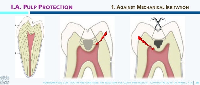 Fundamentals of Tooth Preparation - 2019
