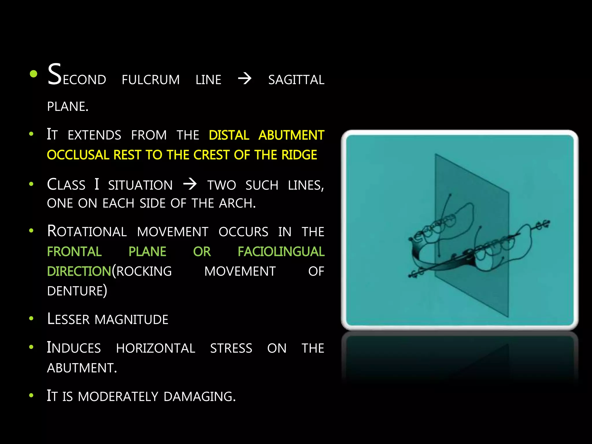 Principles of designing in Removable Partial dentures | PPTX