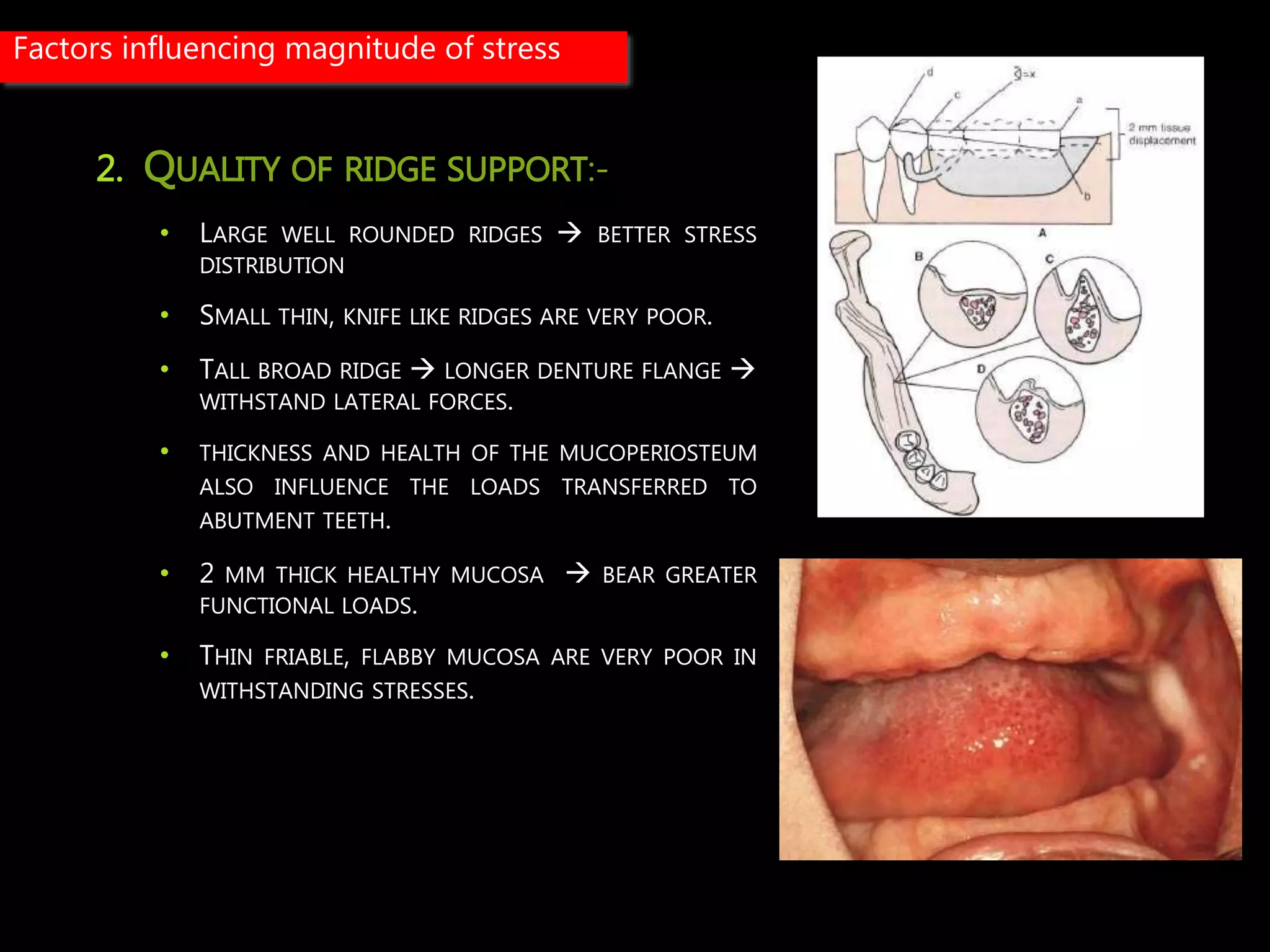 Principles of designing in Removable Partial dentures | PPTX