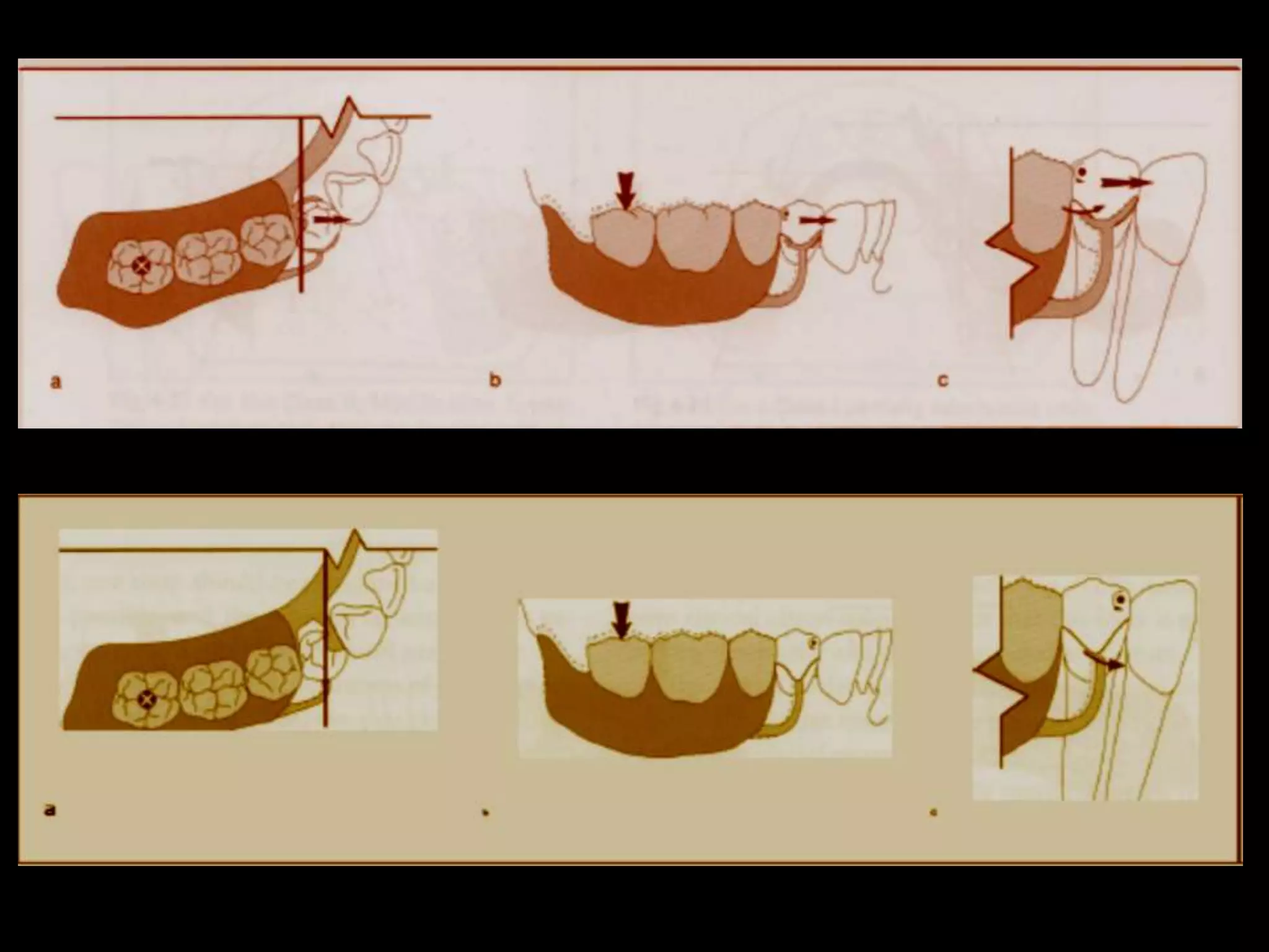 Principles of designing in Removable Partial dentures | PPTX