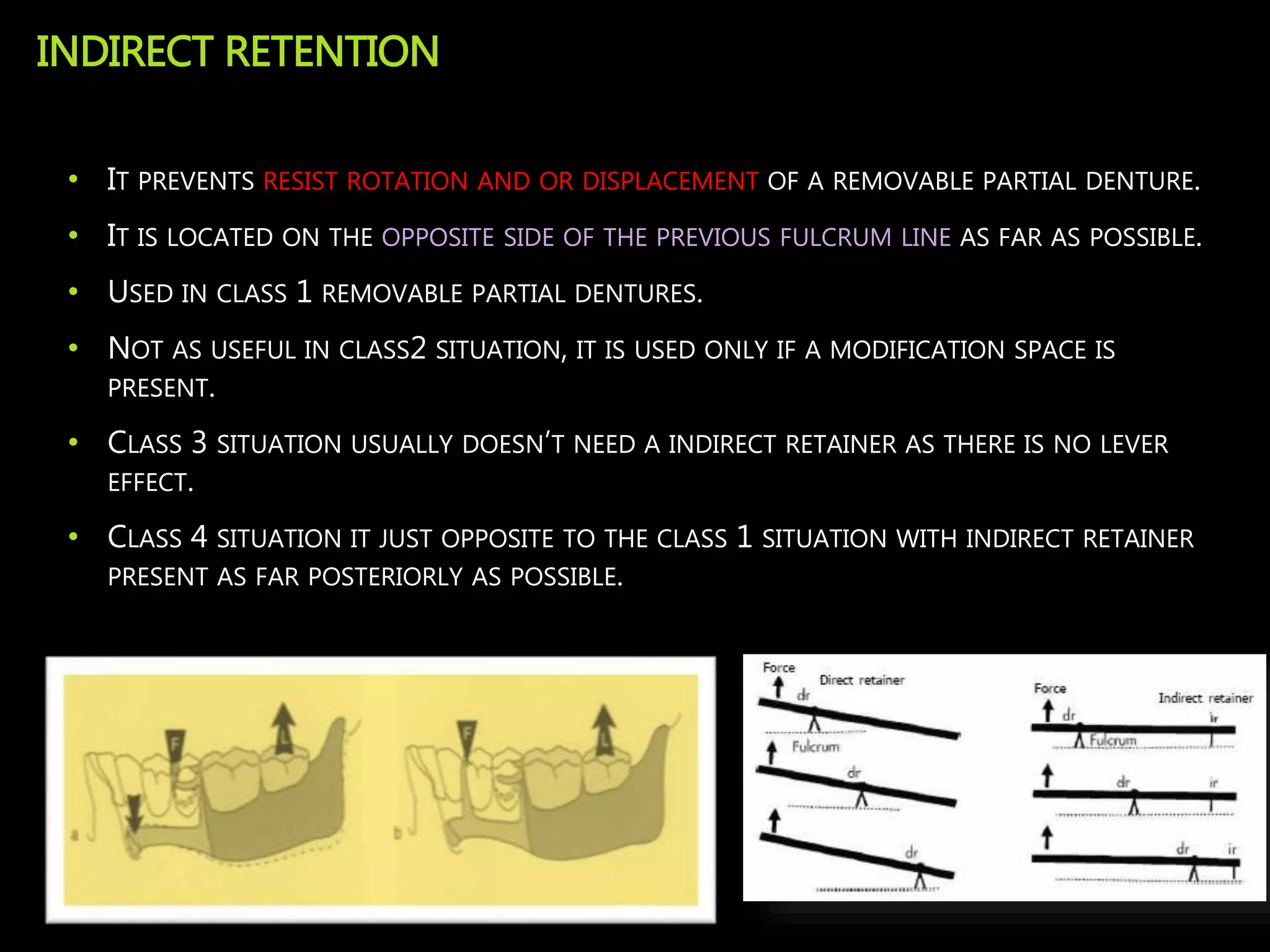 Principles of designing in Removable Partial dentures | PPTX