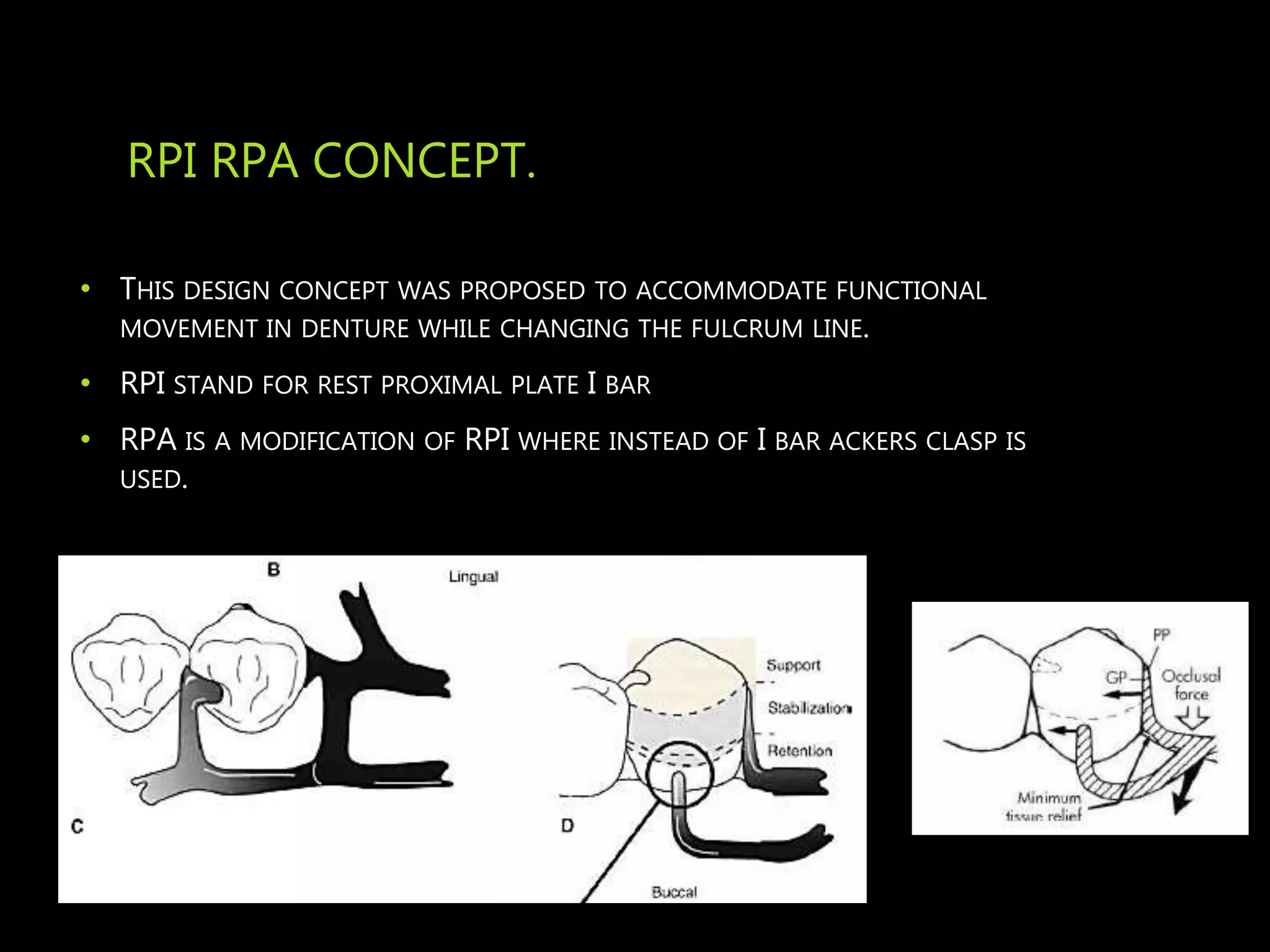 Principles of designing in Removable Partial dentures | PPTX