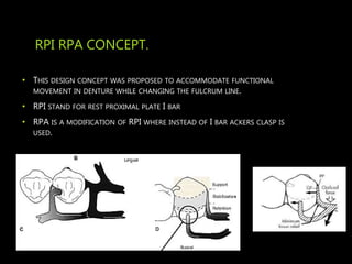 Principles of designing in Removable Partial dentures | PPTX