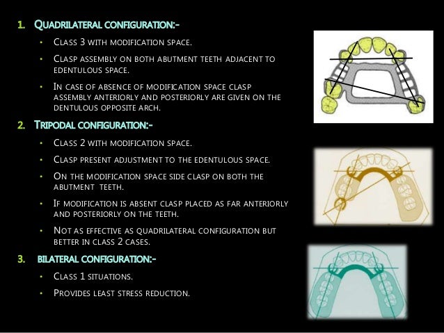 Principles of designing in Removable Partial dentures