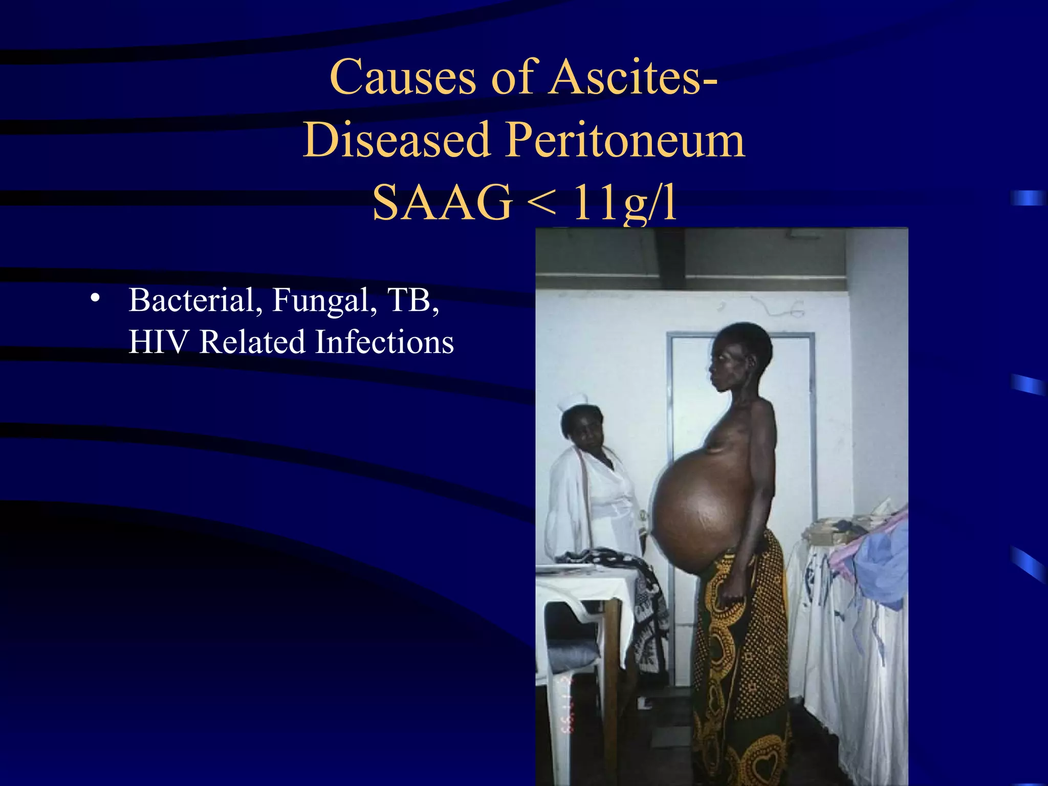Principles Of Management Of Ascites Combined | PPT