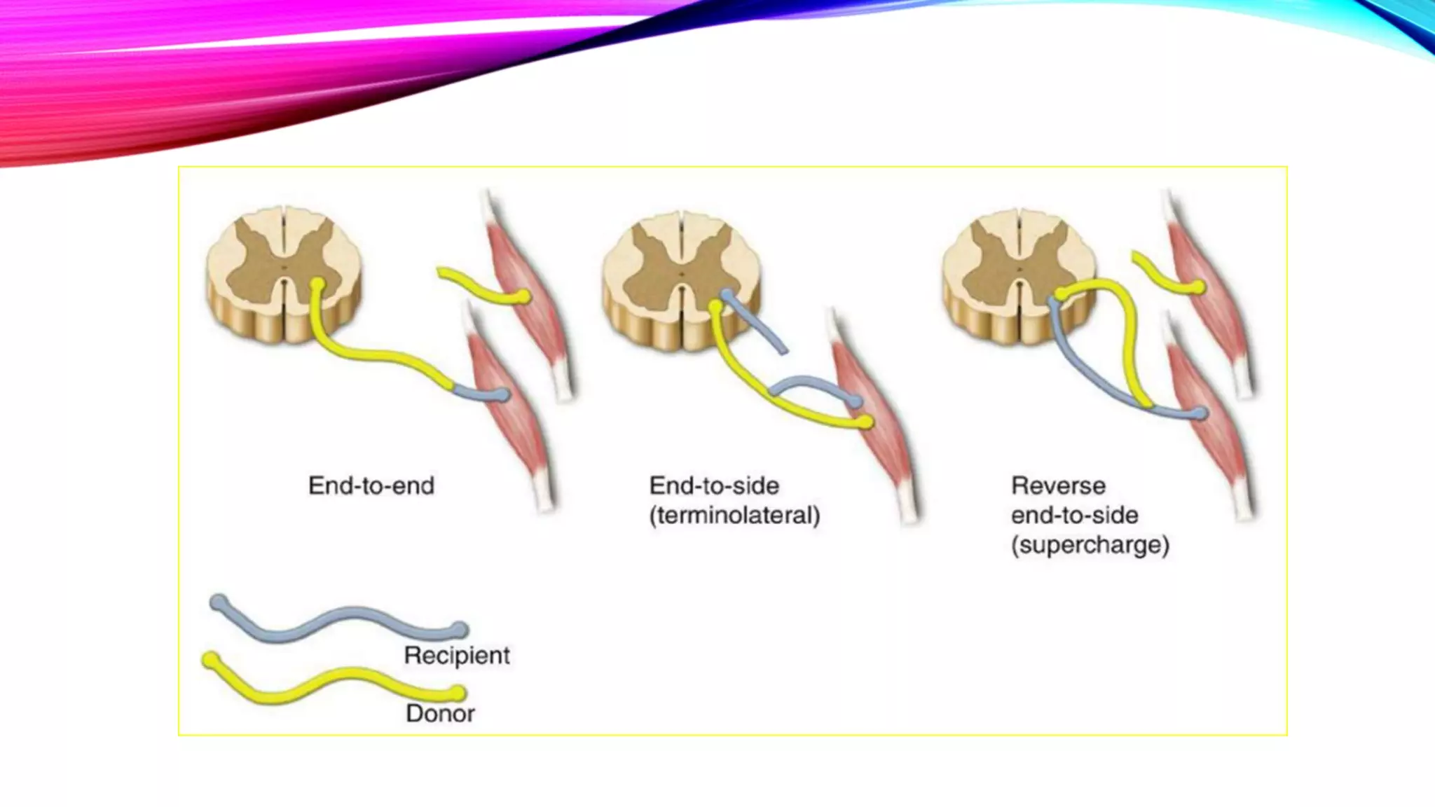 Principles and applications of Nerve transfer by Maheen Fatima.pptx