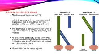 Principles and applications of Nerve transfer by Maheen Fatima.pptx