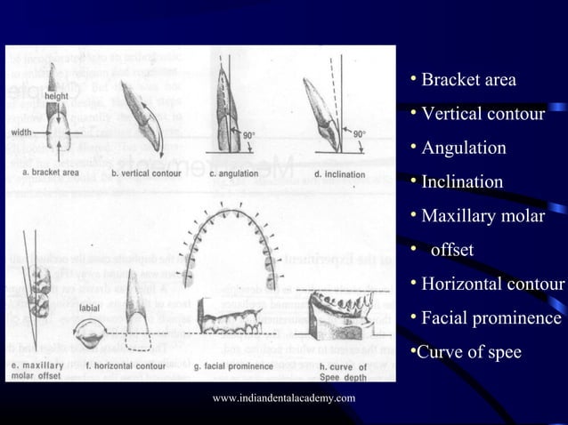 Principles and concept of andrew’s preadjusted edgewise appliance ...