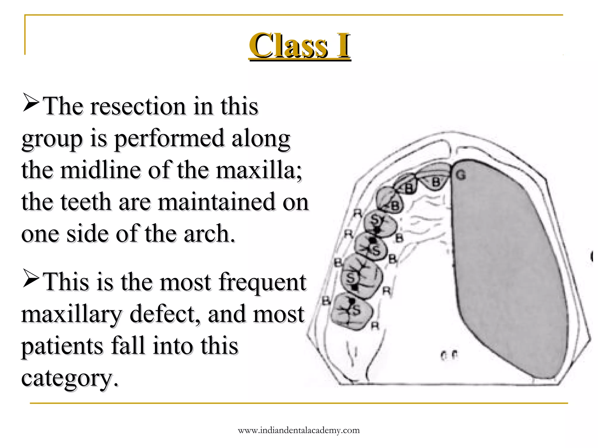 Principles and concepts of designing obturators/ orthodontic seminars | PPT