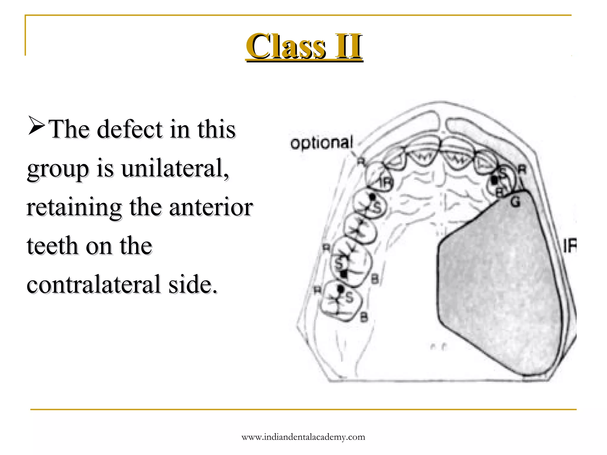 Principles and concepts of designing obturators/ orthodontic seminars | PPT