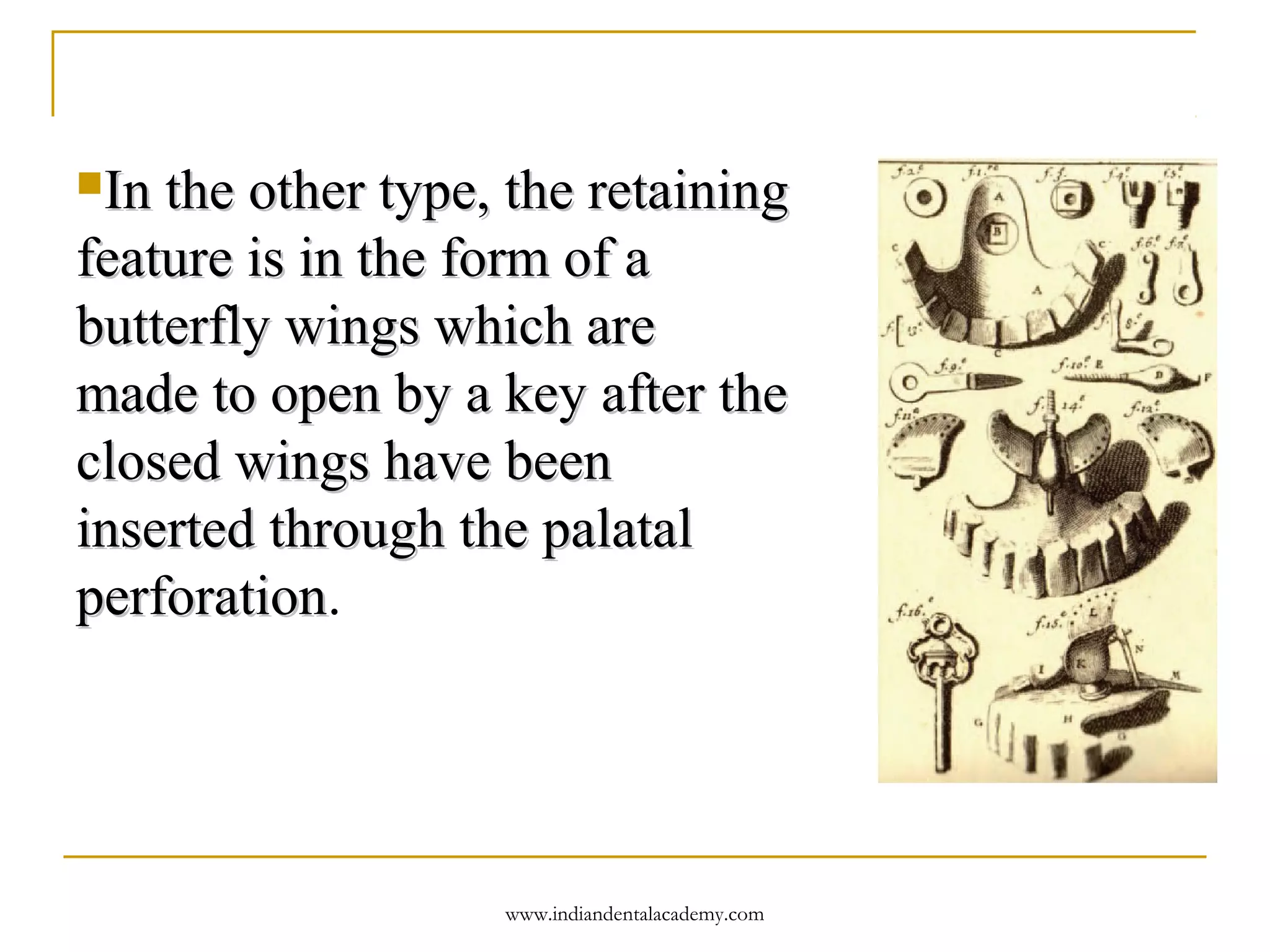 Principles and concepts of designing obturators/ orthodontic seminars | PPT