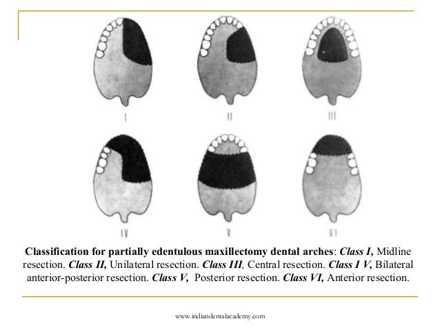 Principles and concepts of designing obturators/ orthodontic seminars