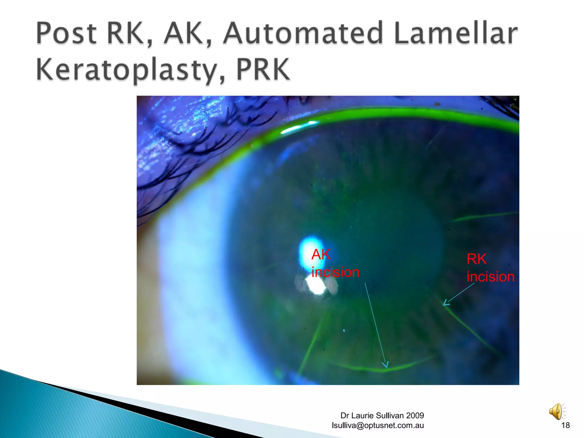 Principles and practice of corneal astigmatic surgery | PPT
