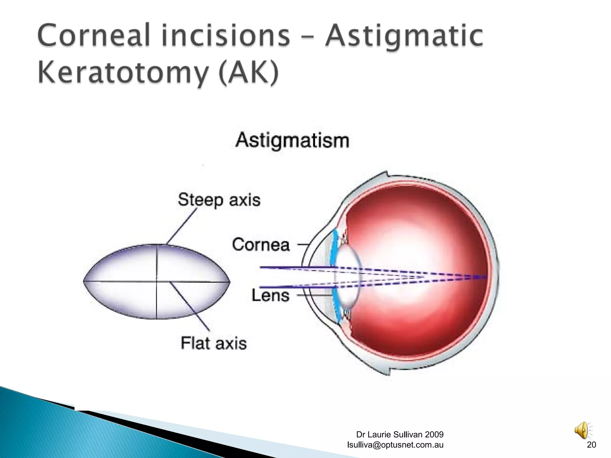 Principles and practice of corneal astigmatic surgery | PPT