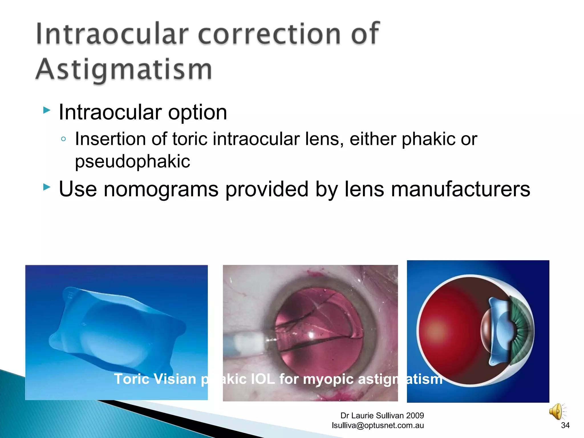 Principles and practice of corneal astigmatic surgery | PPT
