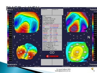Principles and practice of corneal astigmatic surgery | PPT
