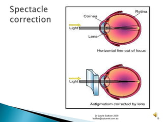 Principles and practice of corneal astigmatic surgery | PPT