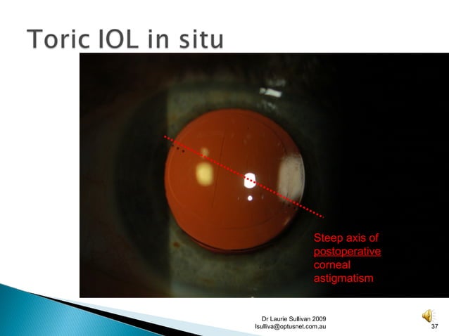 Principles and practice of corneal astigmatic surgery | PPT | Eye and ...