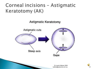 Astigmatic Keratotomy