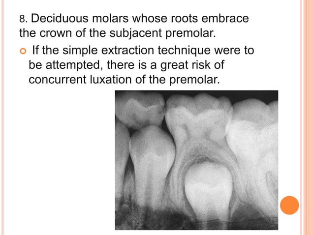 Principles and steps of surgical tooth extraction | PPTX