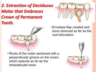 Principles and steps of surgical tooth extraction | PPTX