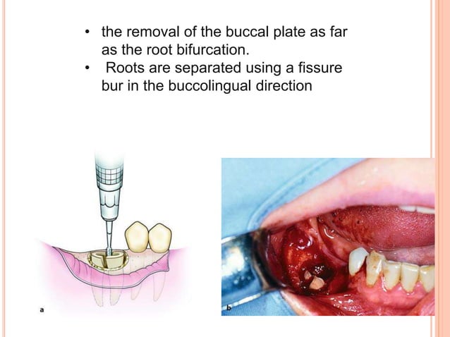 Principles and steps of surgical tooth extraction | PPTX