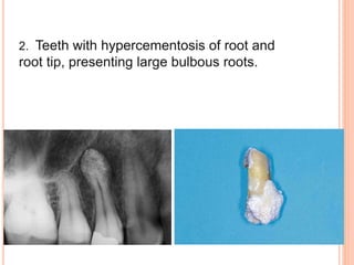 Principles and steps of surgical tooth extraction | PPTX