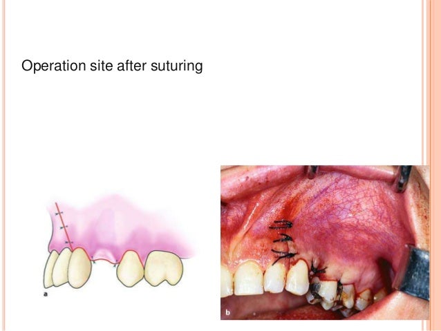 Principles and steps of surgical tooth extraction