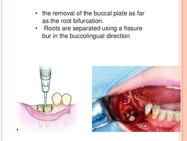 Principles and steps of surgical tooth extraction Principles and steps of surgical tooth extraction