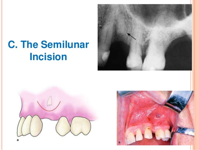 Principles and steps of surgical tooth extraction Principles and steps of surgical tooth extraction