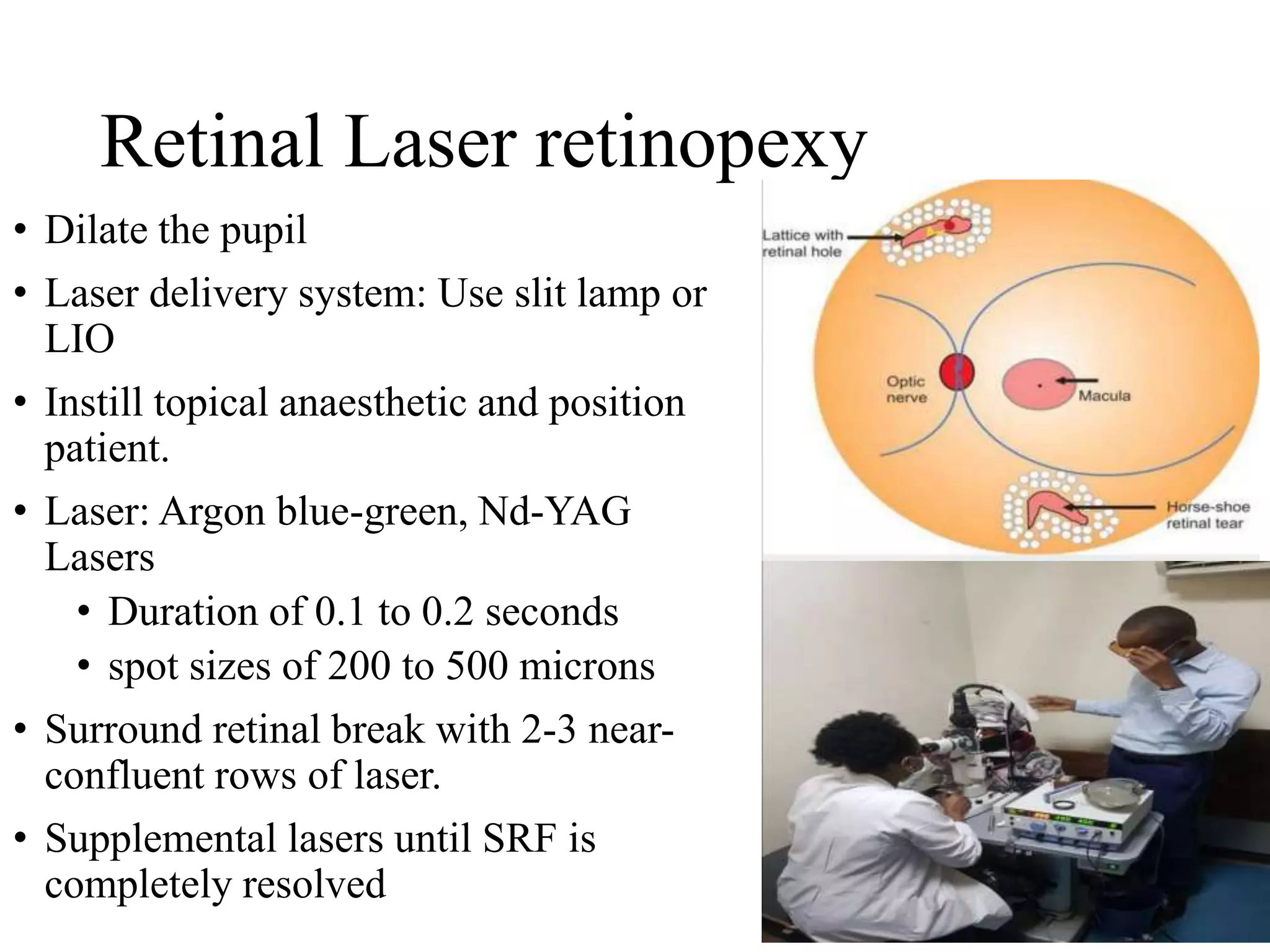 Principles and technique of pneumatic retinopexy (Dr. Avuru C.J).pptx