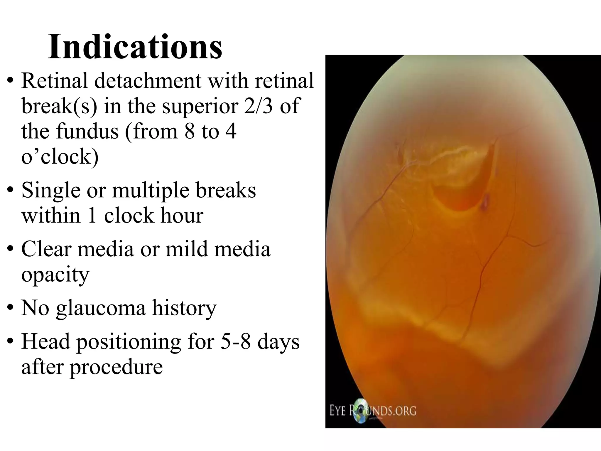 Principles and technique of pneumatic retinopexy (Dr. Avuru C.J).pptx
